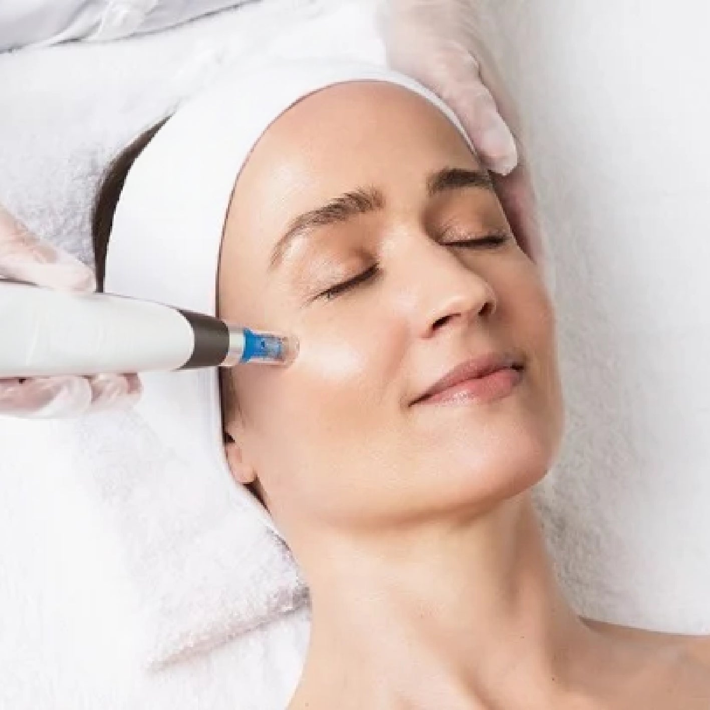 Dermapen Skin Needling Moonee Ponds | Microneedling | ELIIXA