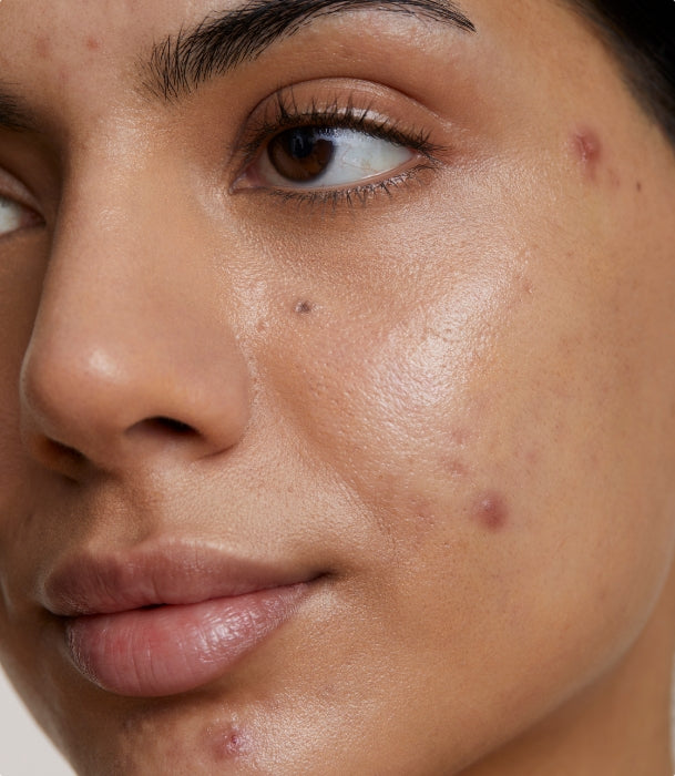 Acne & Acne Scarring Treatment Moonee Ponds | Clear Skin ELIIXA